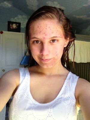 Acne ridden | Is your skin good? - Quiz